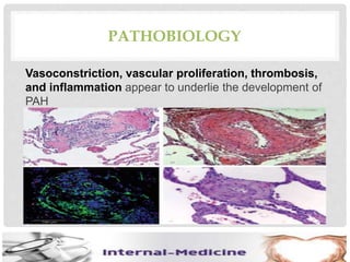 Pulmonary hypertension | PPTX