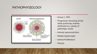 Pulmonary hypertension | PPT