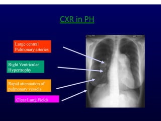 PULMONARY HYPERTENSION, COMPLICATION OF LUNG DISEASES | PPT
