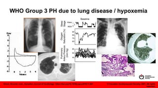 Pulmonary Hypertension -Slide.ppt