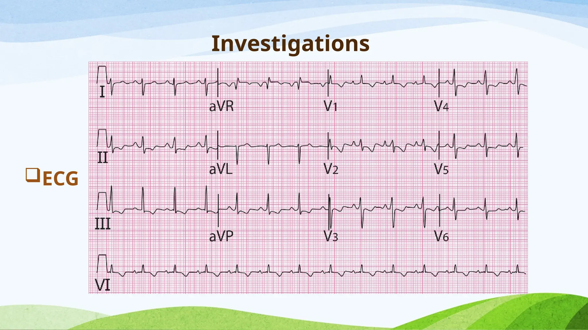 Approach to Pulmonary Hypertension Diagnosis & Management | PPTX