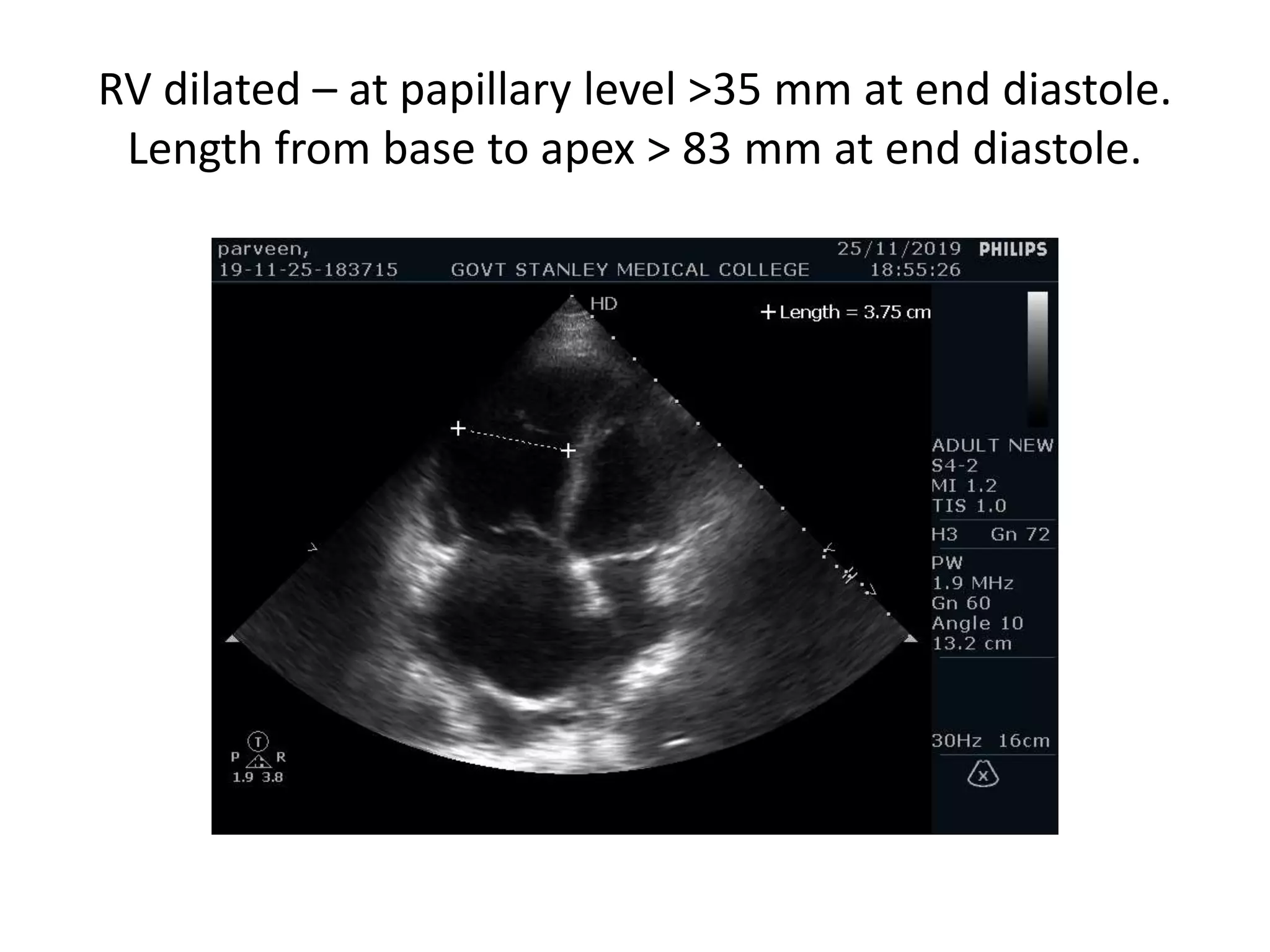 Pulmonary hypertension echo | PPTX
