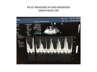 Pulmonary hypertension echo | PPTX
