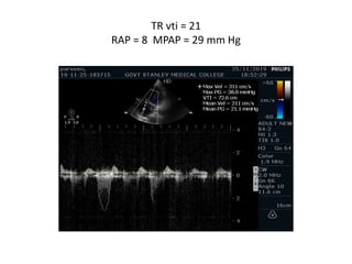 Pulmonary hypertension echo | PPTX