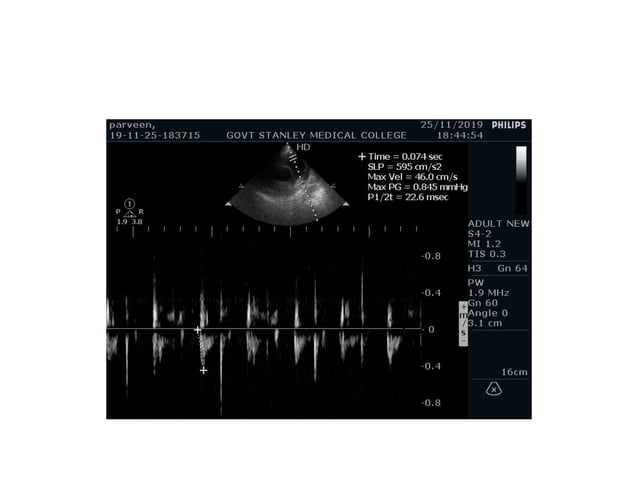 Pulmonary hypertension echo | PPTX