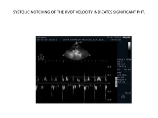Pulmonary hypertension echo | PPTX