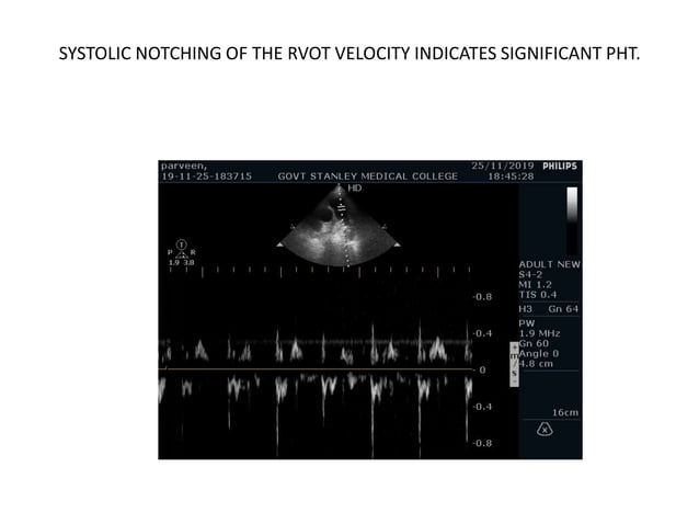 Pulmonary hypertension echo | PPTX