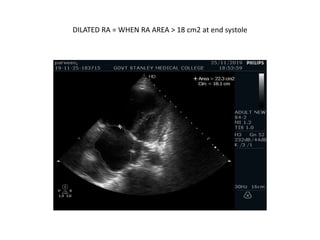 Pulmonary hypertension echo | PPTX