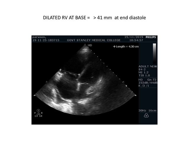 Pulmonary hypertension echo | PPTX