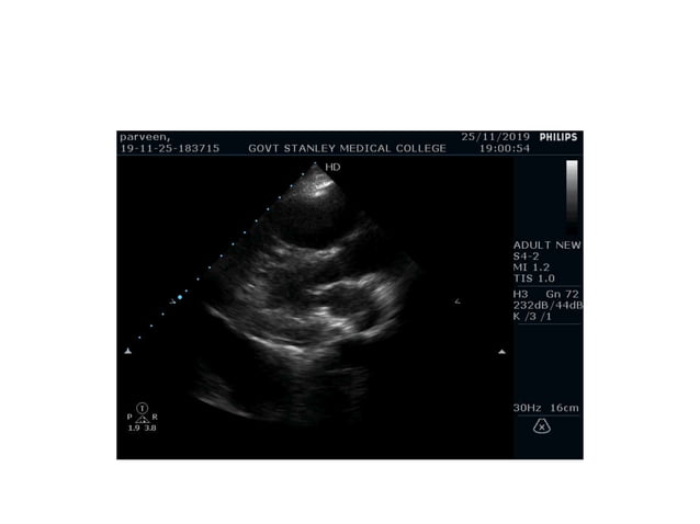 Pulmonary hypertension echo | PPTX