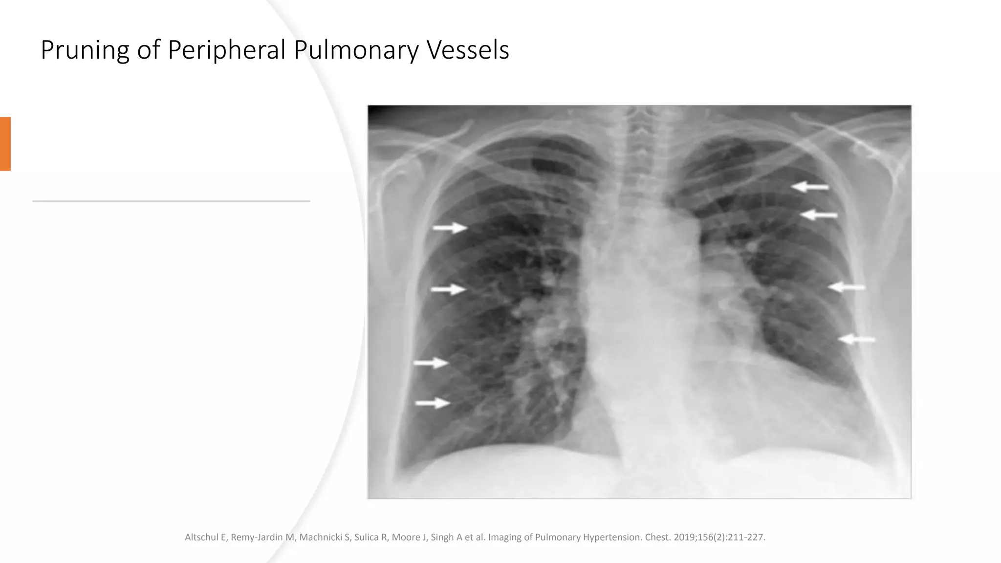 Pulmonary hypertension Pathophysiology and diagnosis [Autosaved].pptx