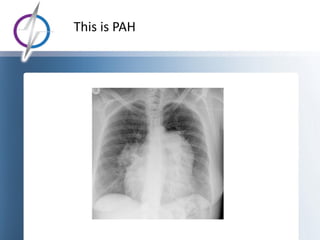 Examining Drug Candidates for Pulmonary Arterial Hypertension: The Ups ...