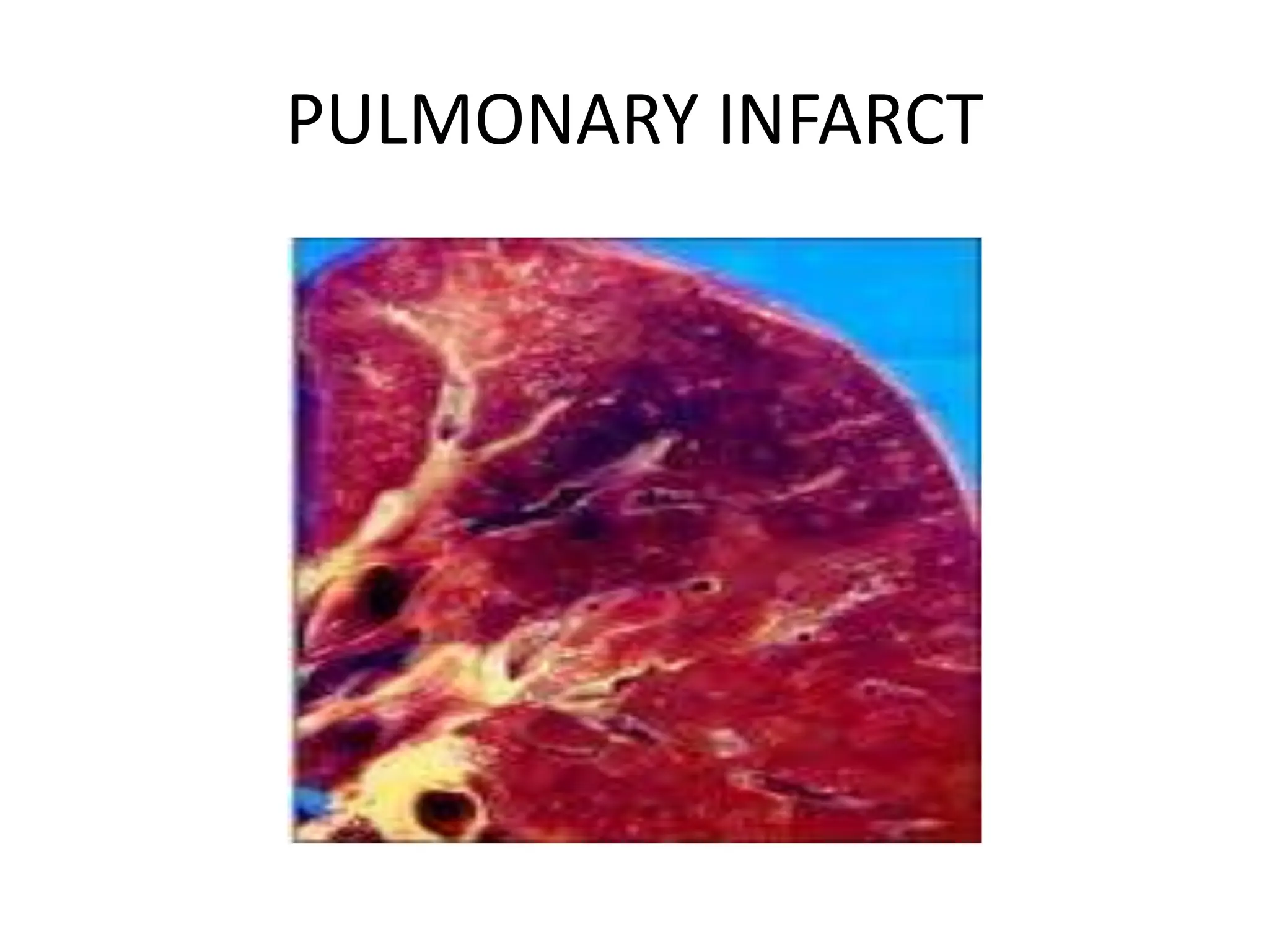 pulmonary infarction and pulmonary embolism .pptx
