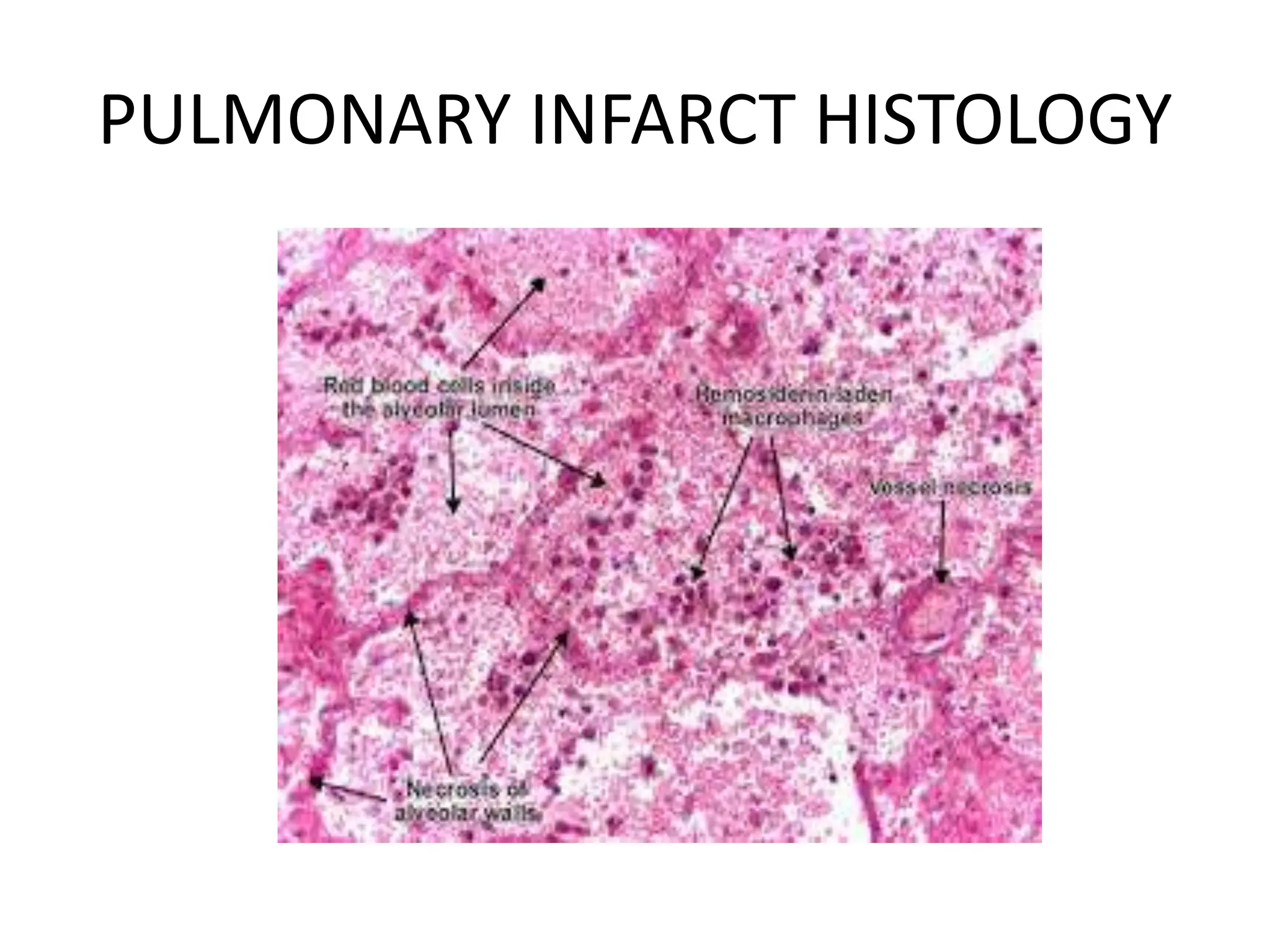 pulmonary infarction and pulmonary embolism .pptx