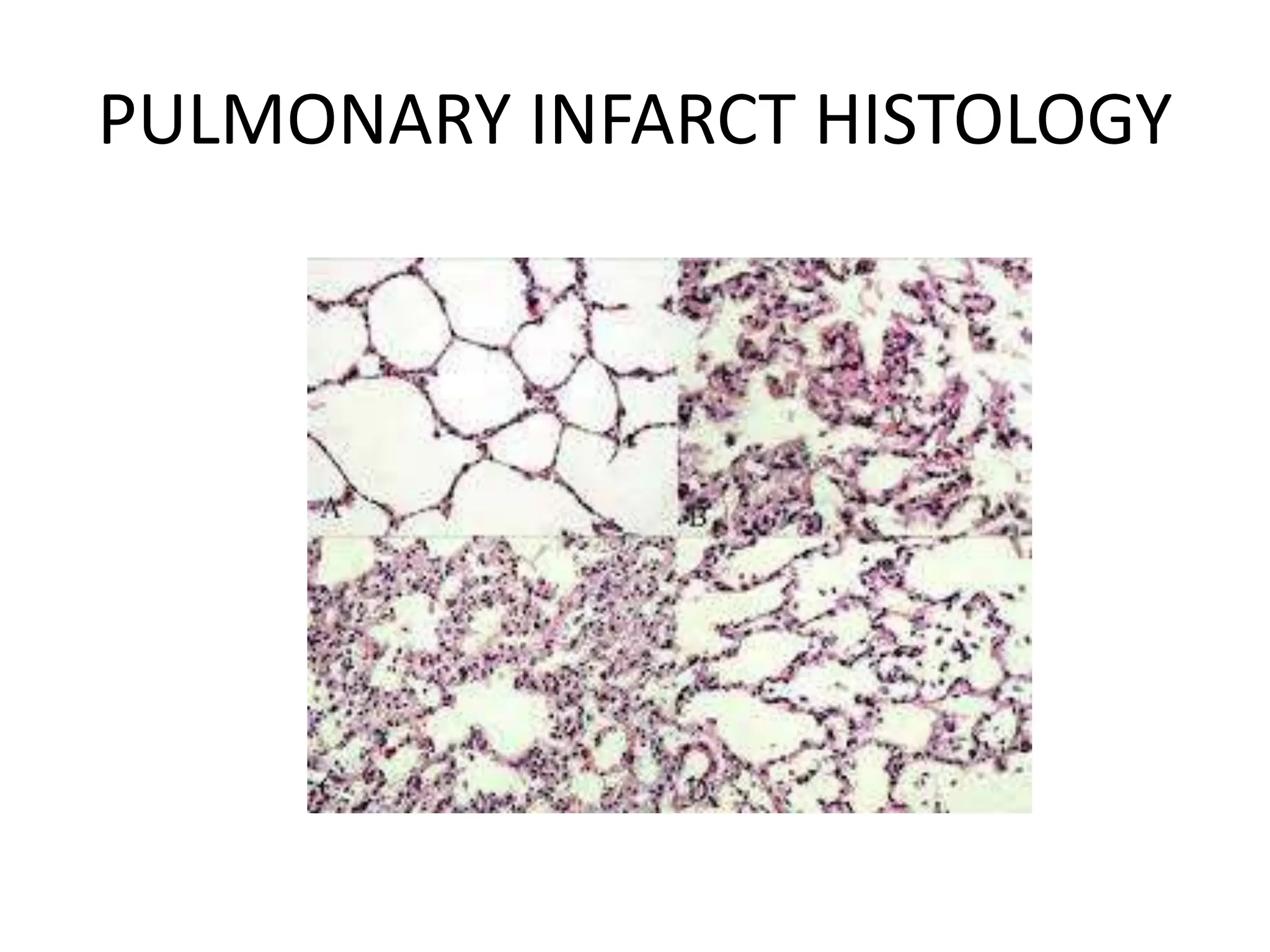 Pulmonary Infarction And Pulmonary Embolism Pptx