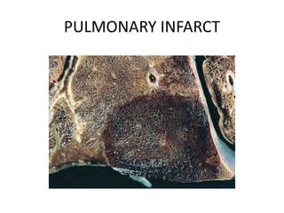 pulmonary infarction and pulmonary embolism .pptx