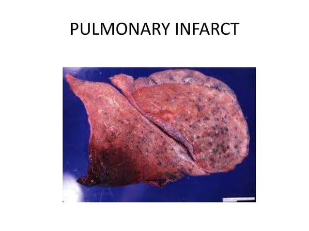 pulmonary infarction and pulmonary embolism .pptx | Lung and ...