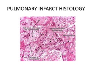 pulmonary infarction and pulmonary embolism .pptx | Lung and ...