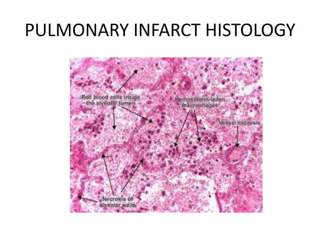 pulmonary infarction and pulmonary embolism .pptx | Lung and Respiratory Health | Diseases and ...