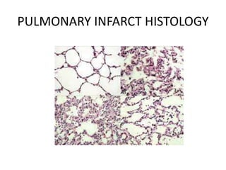 pulmonary infarction and pulmonary embolism .pptx