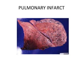 basics of pulmonary infarction powerpoint.pptx