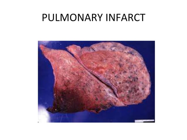 basics of pulmonary infarction powerpoint.pptx