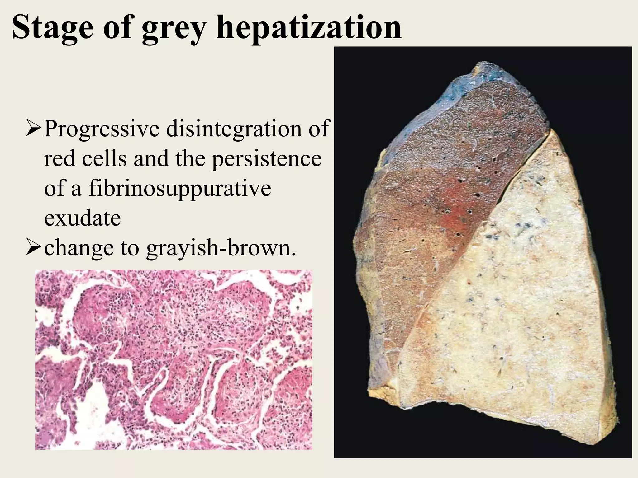 Pulmonary Infection (2).pptx