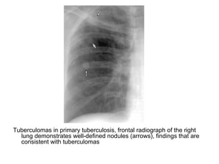Diagnostic Imaging of Pulmonary infections | PPT