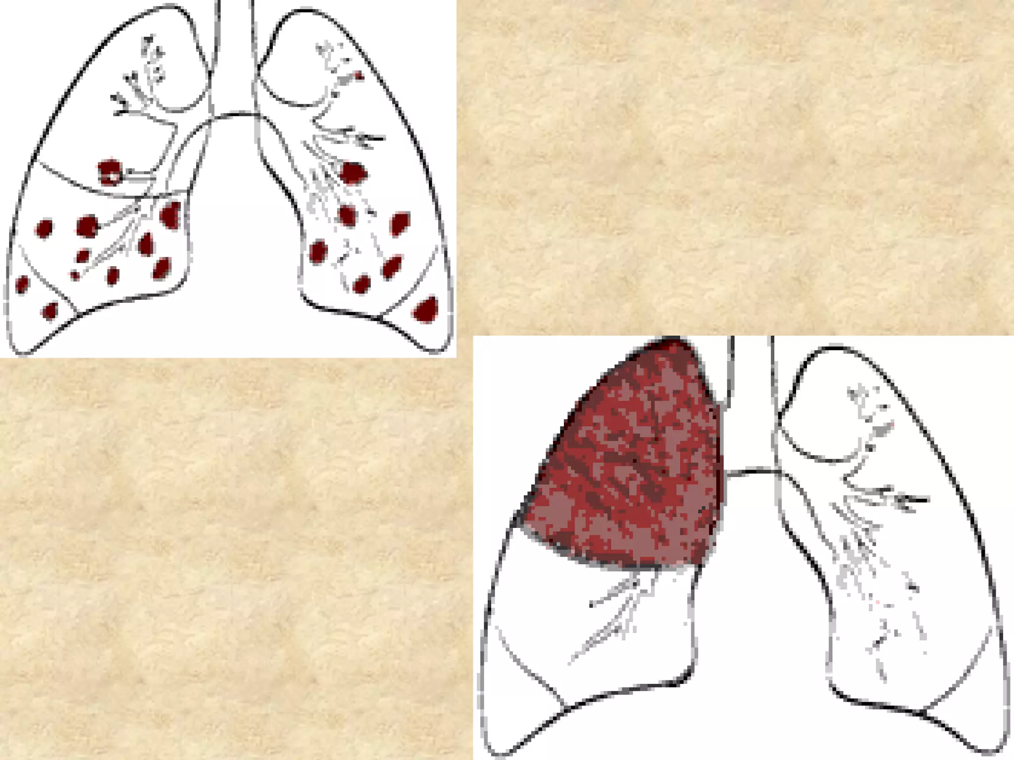 Pulmonary Infections | PDF