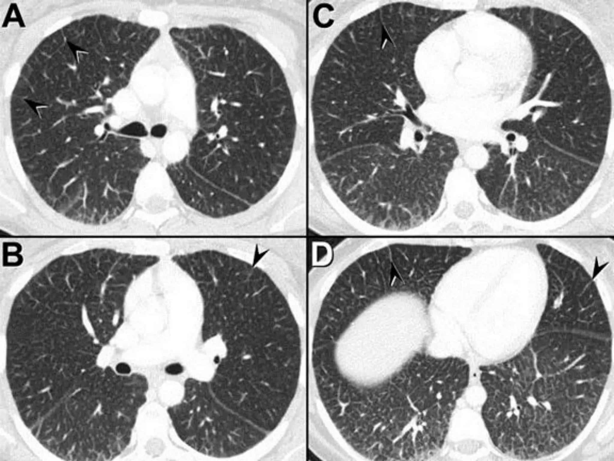 Pulmonary interstitium | PDF