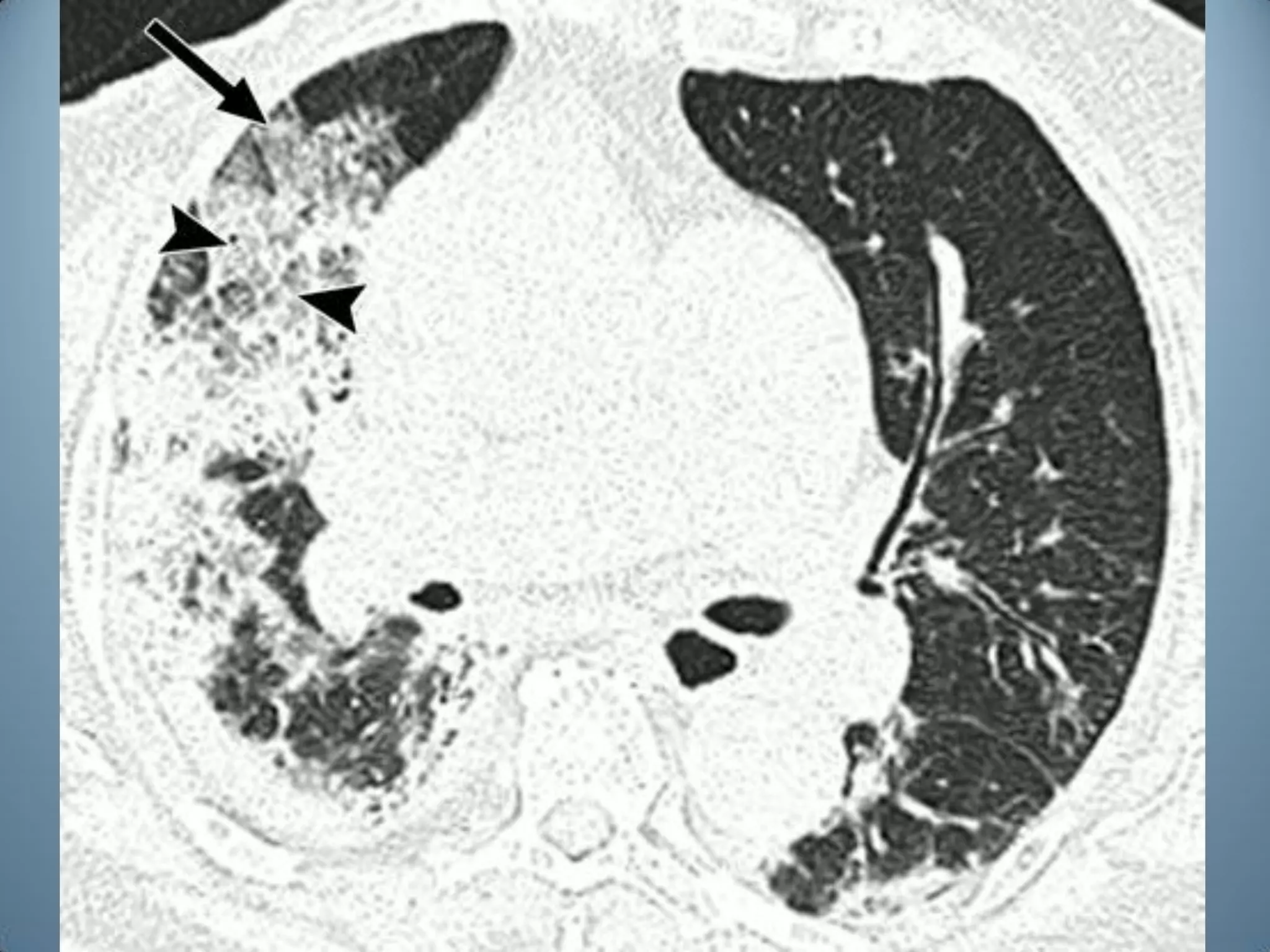 Pulmonary interstitium | PDF