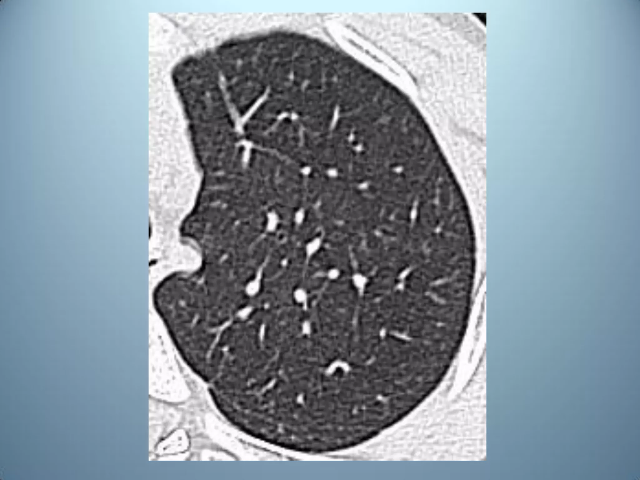 Pulmonary interstitium | PDF