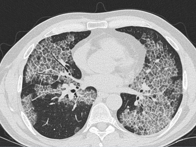 Pulmonary interstitium