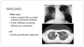 Pulmonary involvement in peoples living with HIV | PPTX