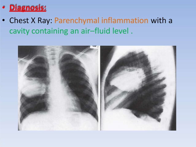pulmonary Lung Abscess.pptx