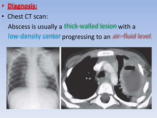pulmonary Lung Abscess.pptx