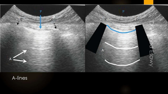 lung ultrasound all thing you want to know Dr Ahmed Esawy | PPT