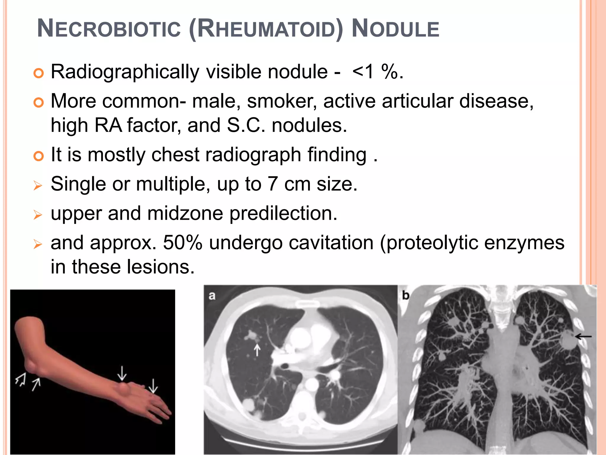 Pulmonary manifestations of collagen vascular diseases | PPTX