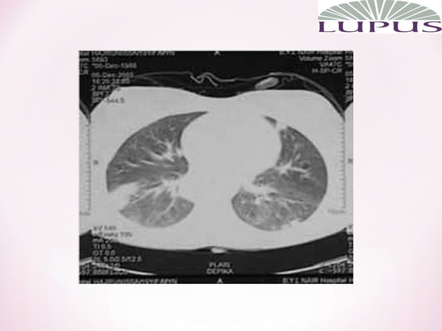 Pulmonary manifestations of SLE | PPT