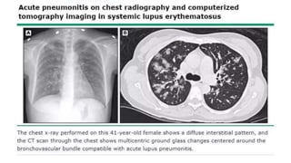 Pulmonary Manifestations of SLE.pptxpt | PPT | Lung and Respiratory ...