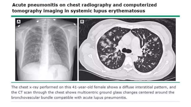 Pulmonary Manifestations of SLE.pptxpt | PPT | Lung and Respiratory ...