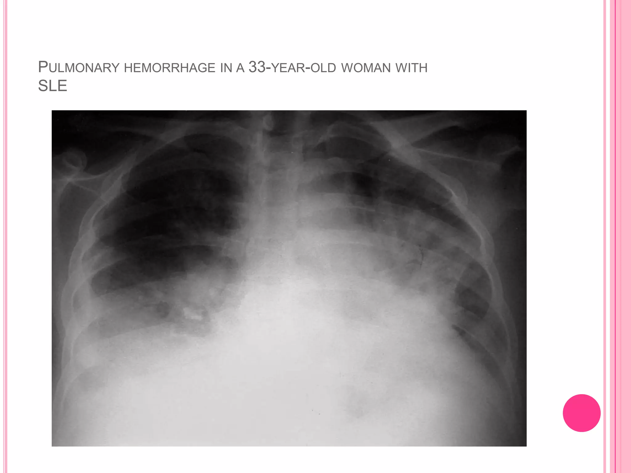 Pulmonary manifestations of systemic lupus erythematosis | PPTX