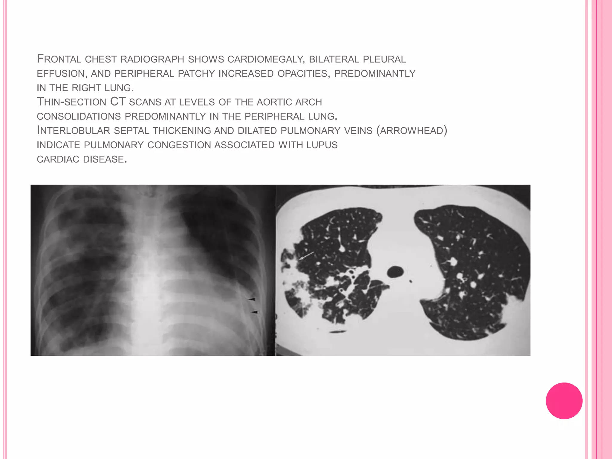 Pulmonary manifestations of systemic lupus erythematosis | PPTX