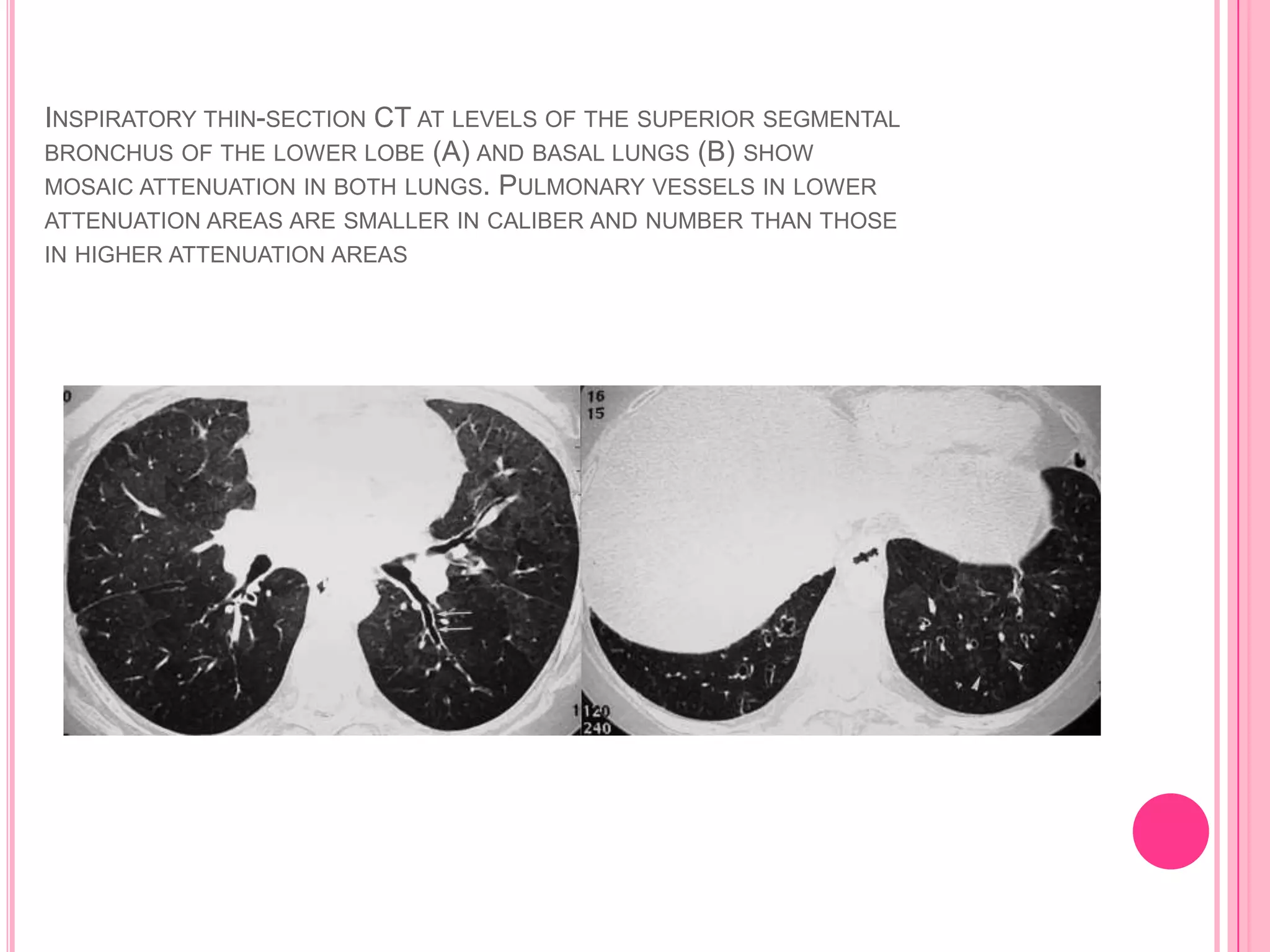 Pulmonary manifestations of systemic lupus erythematosis | PPTX