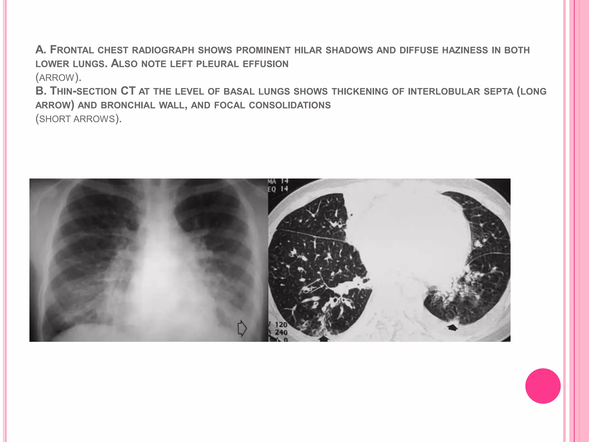 Pulmonary manifestations of systemic lupus erythematosis | PPTX
