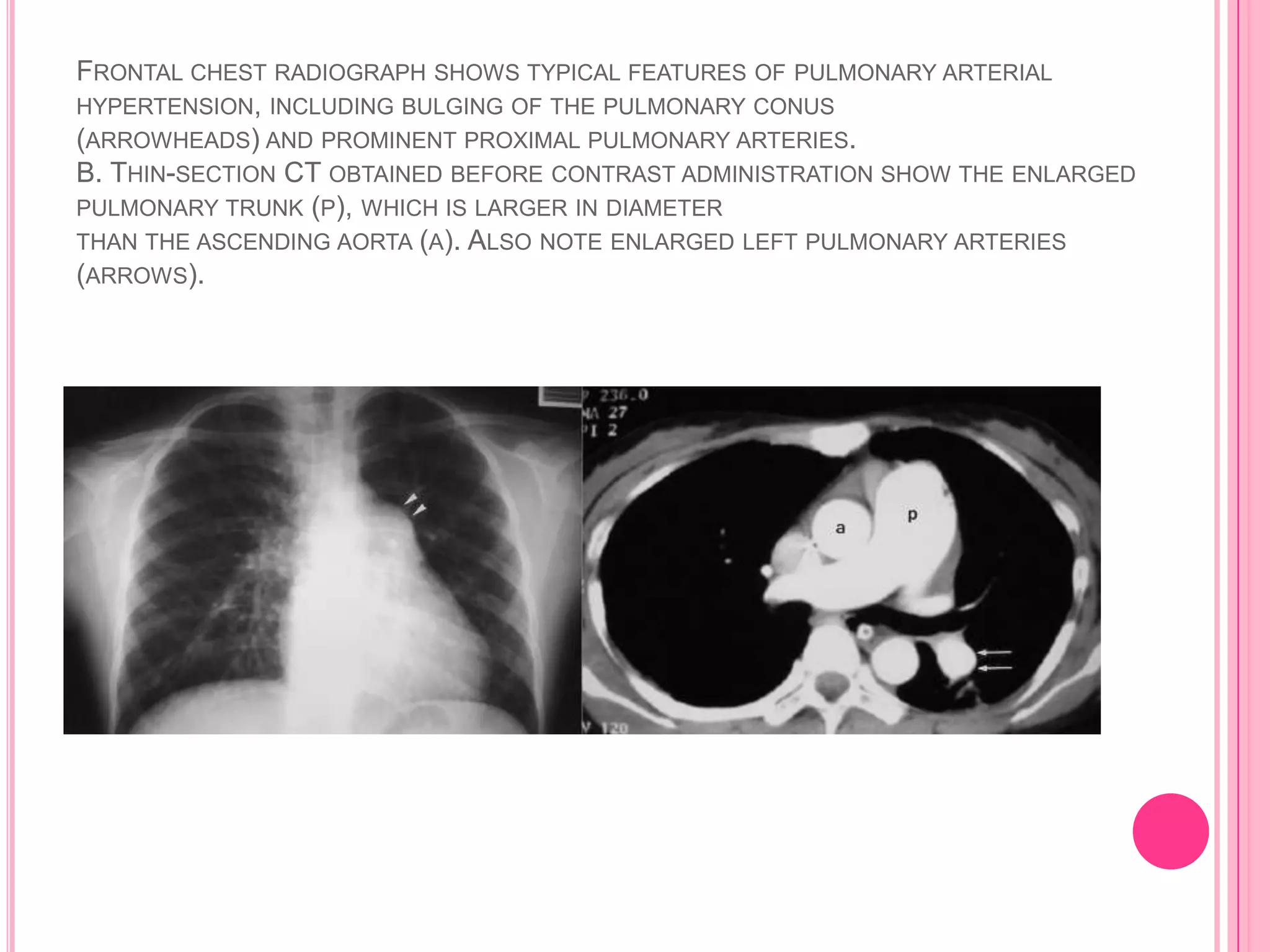 Pulmonary manifestations of systemic lupus erythematosis | PPTX