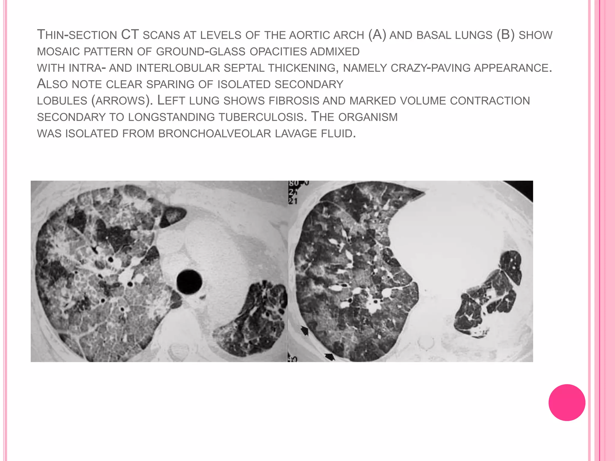 Pulmonary manifestations of systemic lupus erythematosis | PPTX