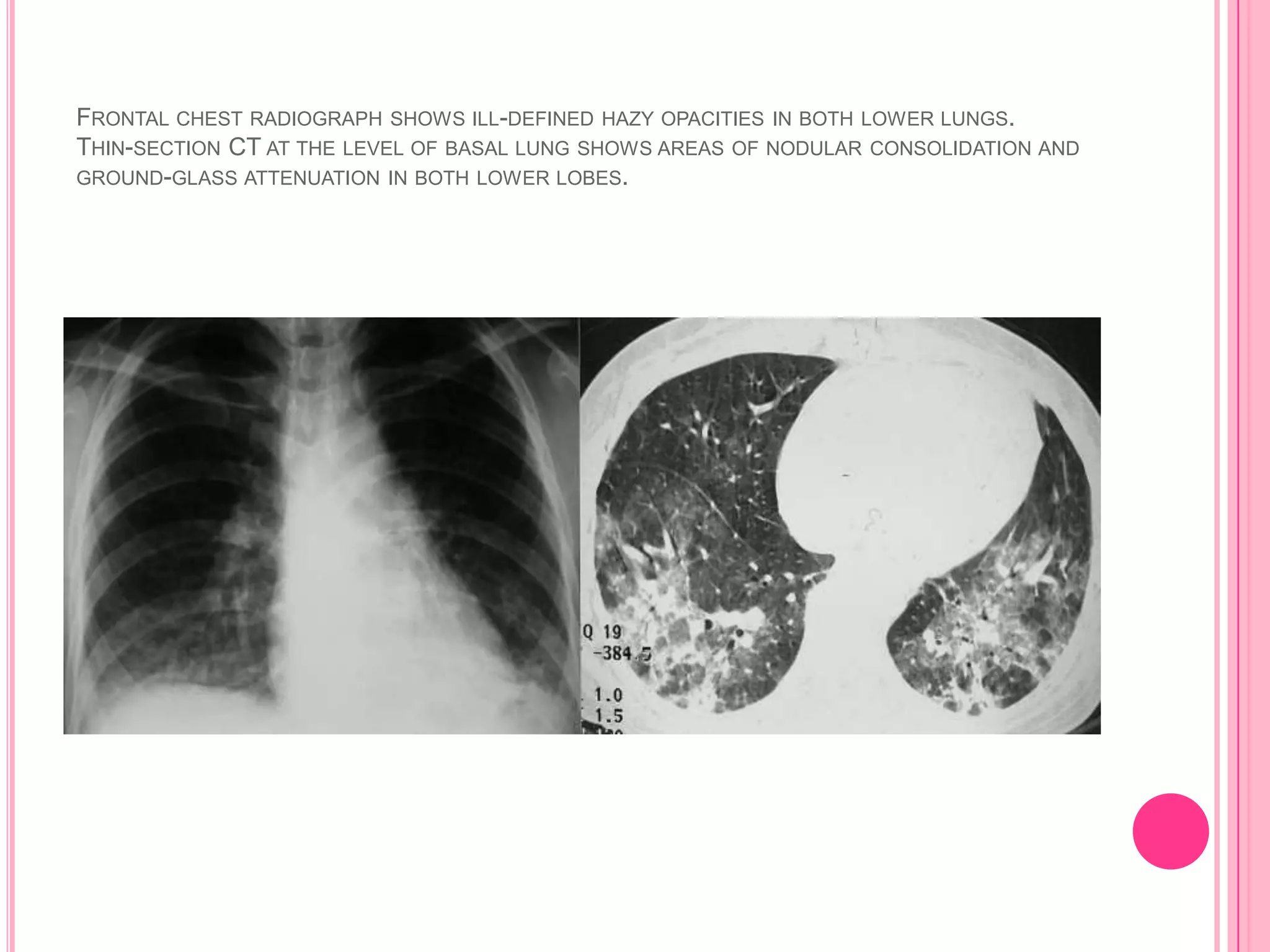 Pulmonary manifestations of systemic lupus erythematosis | PPTX