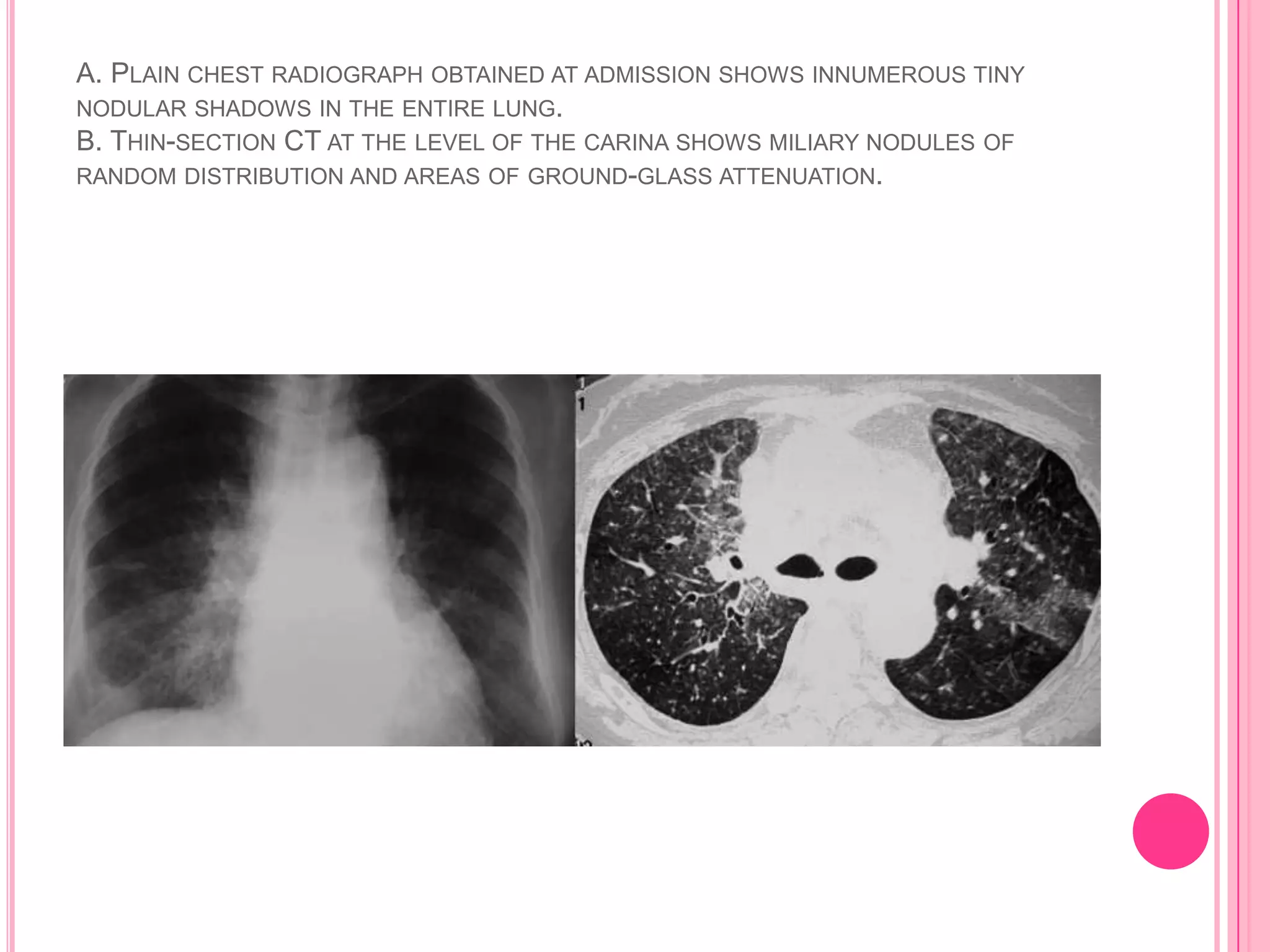 Pulmonary manifestations of systemic lupus erythematosis | PPTX