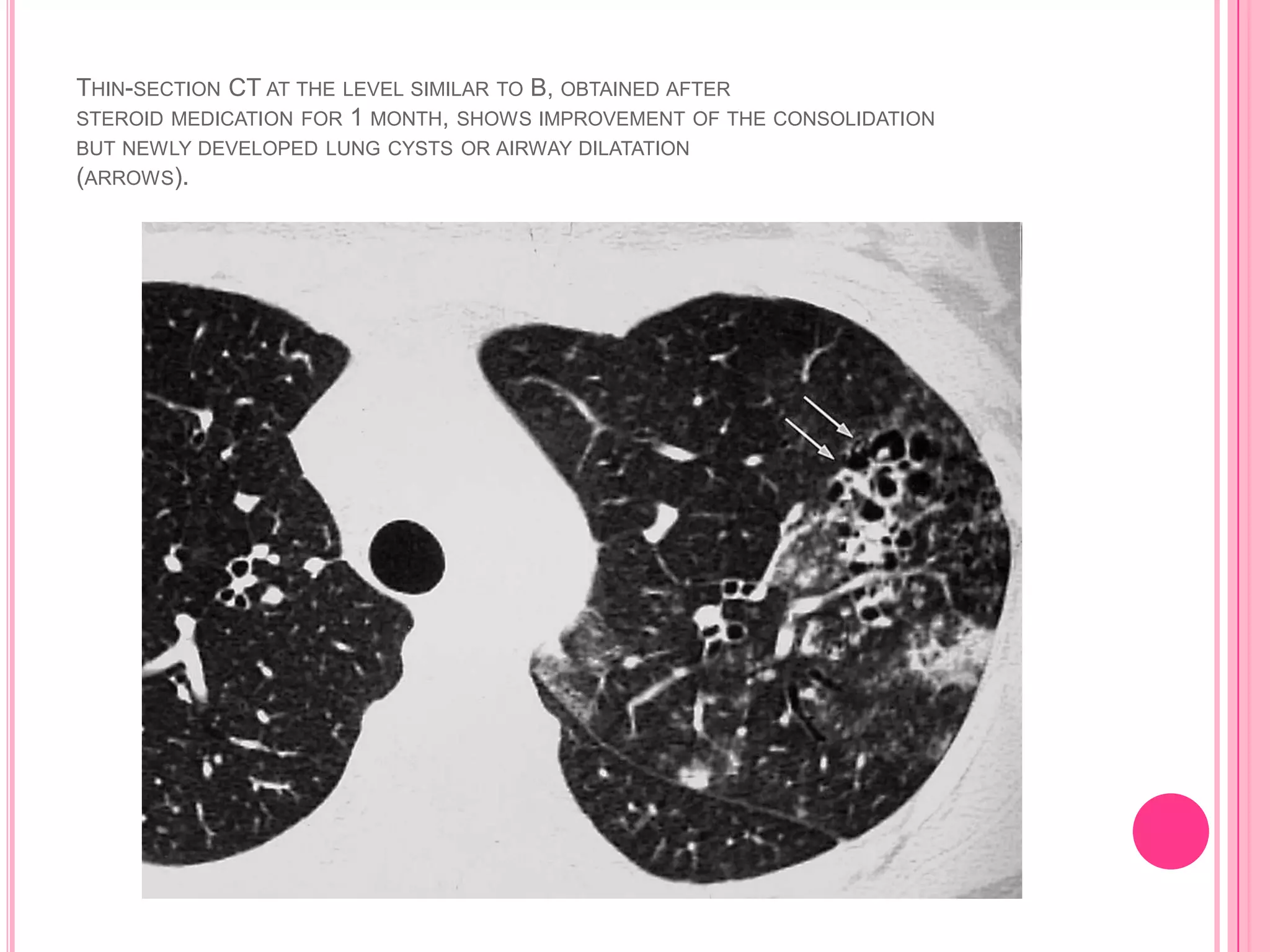 Pulmonary manifestations of systemic lupus erythematosis | PPTX